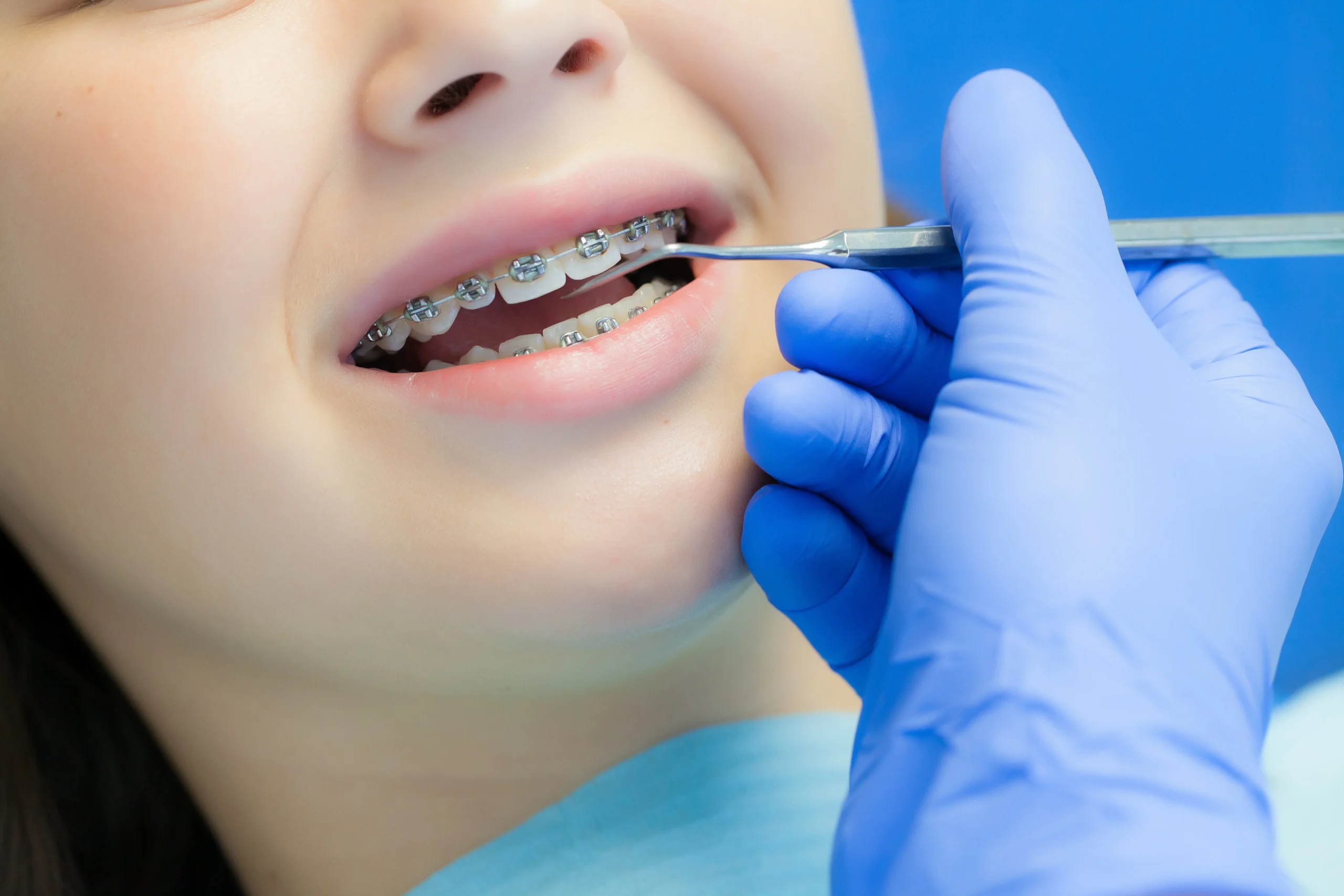 Affordable Braces In Turkey | DentSpa