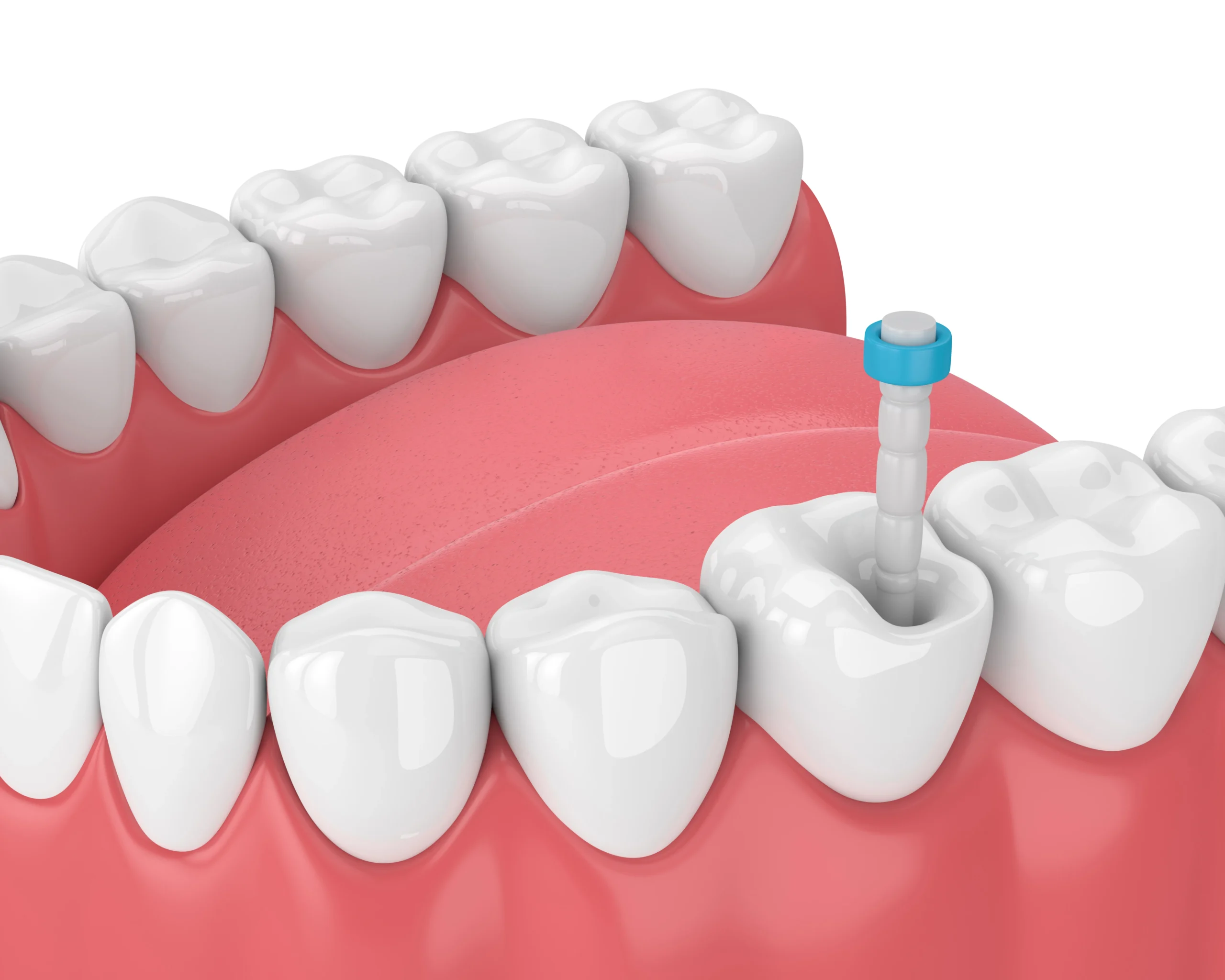 Fiber Post in Türkiye: World-Class Dental Care at Competitive Prices ...