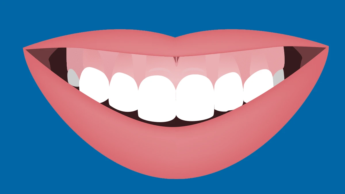 Gummy Smile? Causes, Fixes & Real Results — Dentspa Clinic